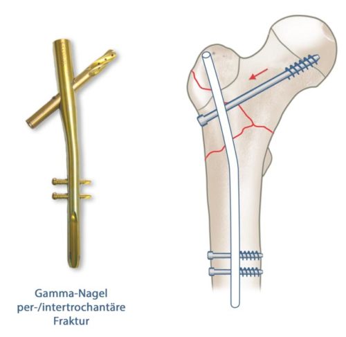 Oberschenkel – mySurgery
