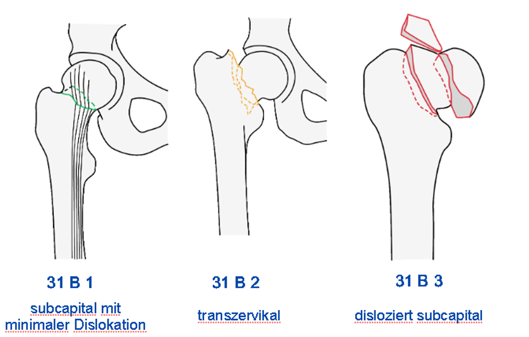 Proximales Femur – mySurgery