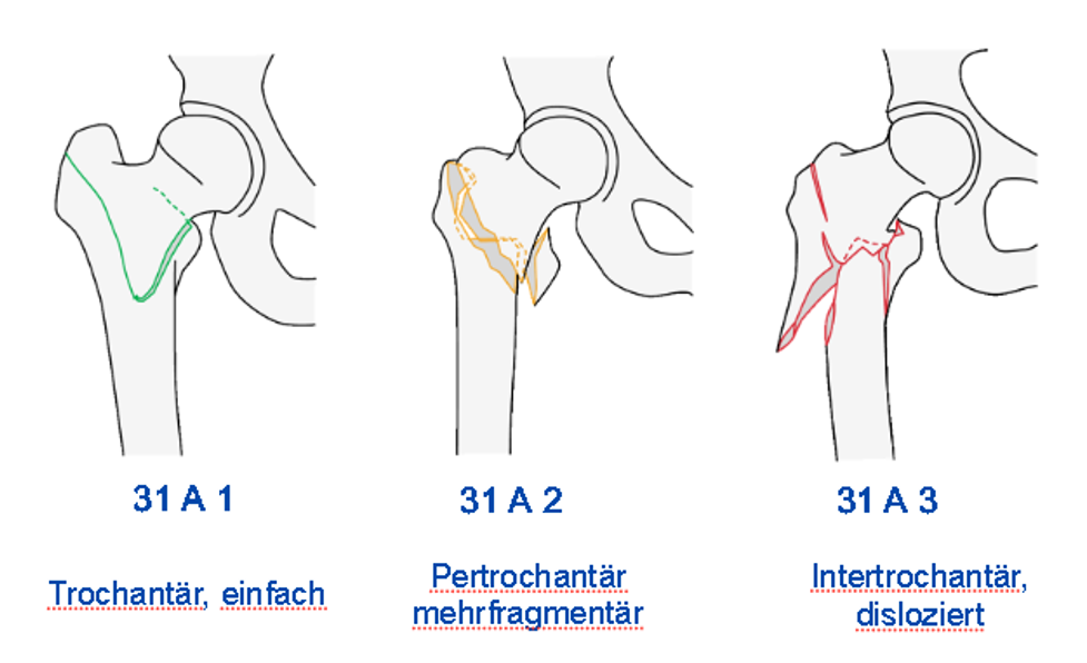 Proximales Femur – mySurgery