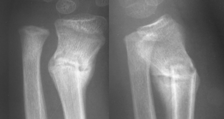 Frakturen im Kindesalter – mySurgery
