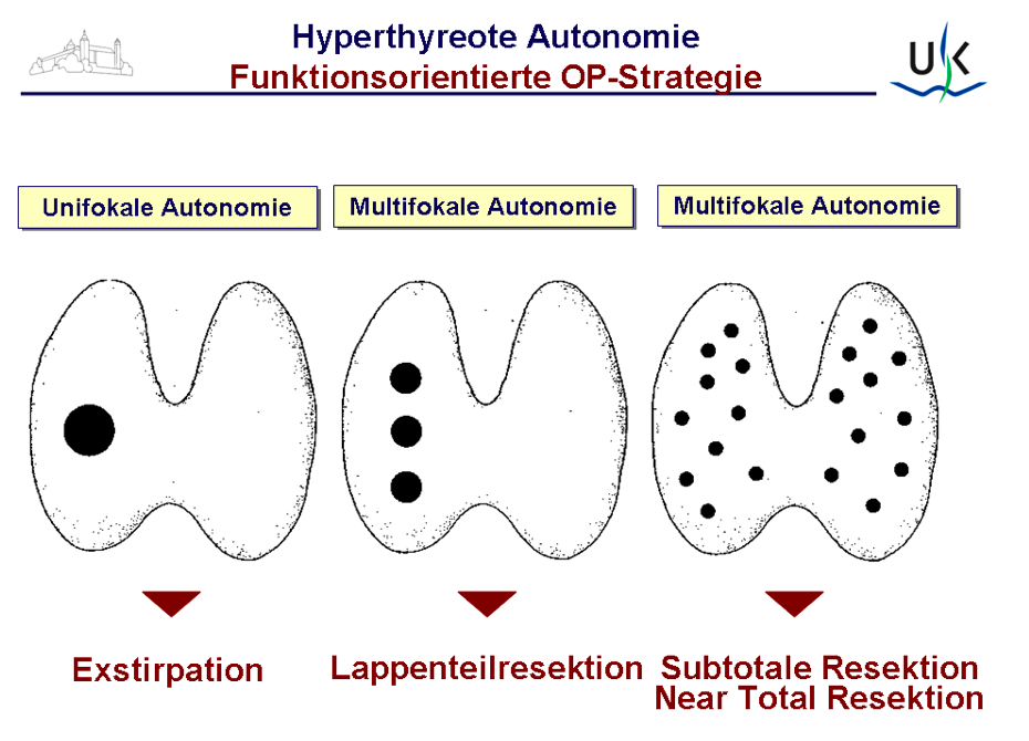 mySurgery | Struma benigna