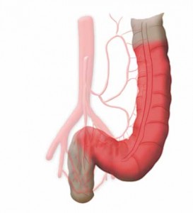 Divertikulitis – mySurgery