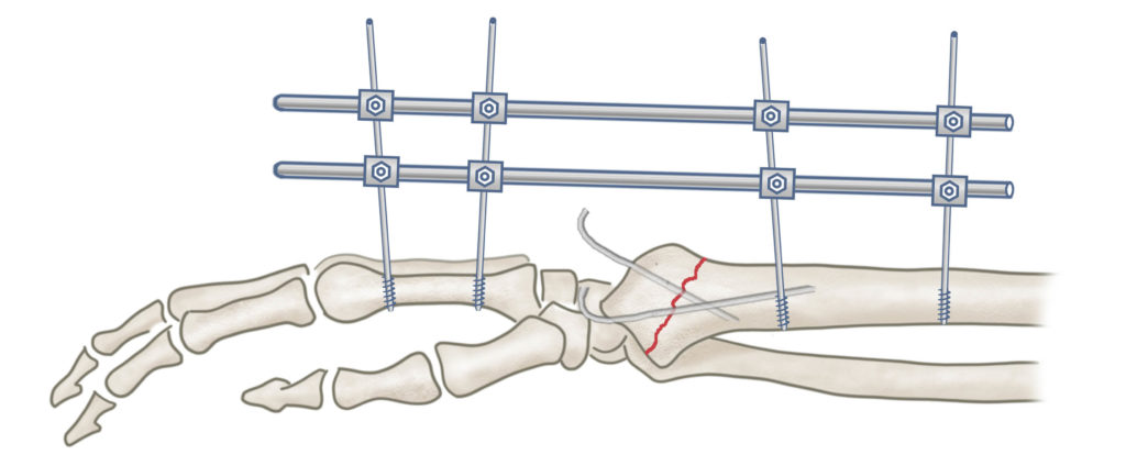 mySurgery | Unterarm und Handgelenk
