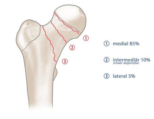 Oberschenkel – mySurgery