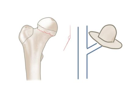 mySurgery | Oberschenkel