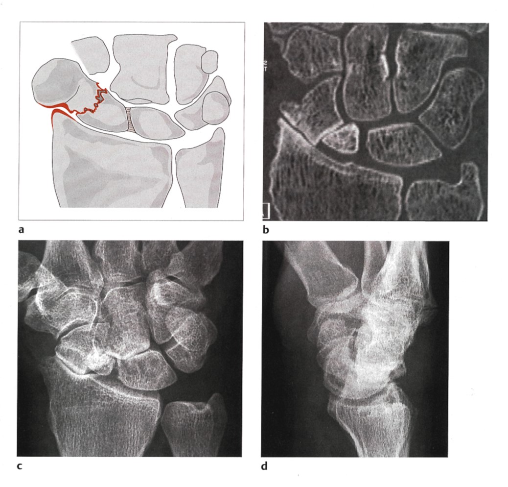 Differenzialdiagnose chronischer Handgelenksschmerzen – mySurgery
