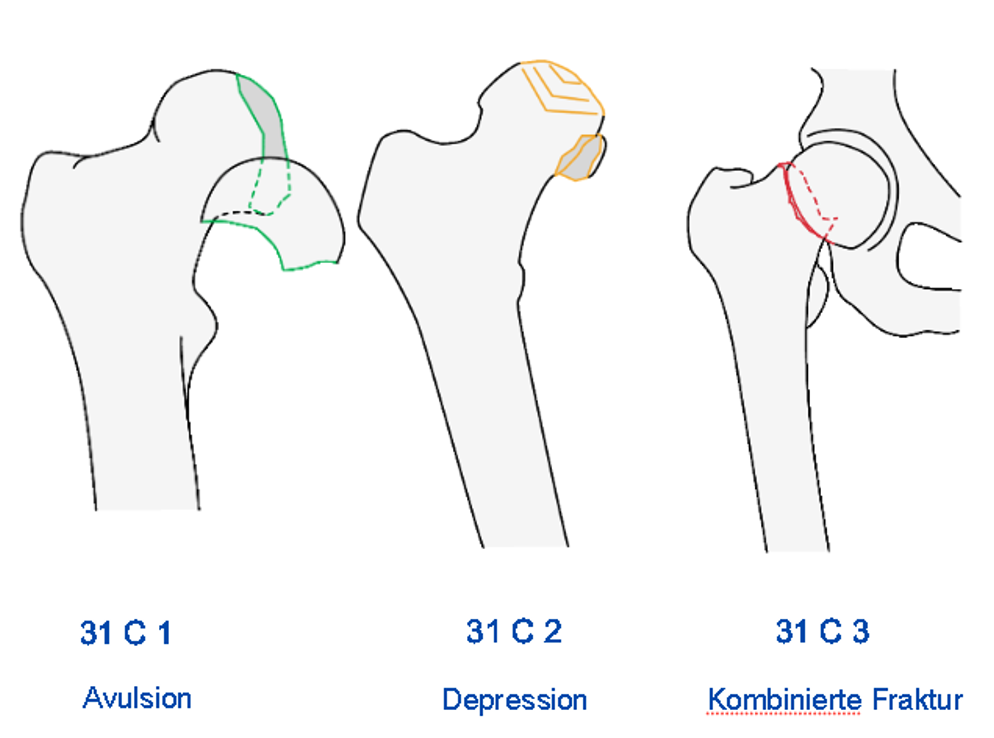 Proximales Femur – mySurgery