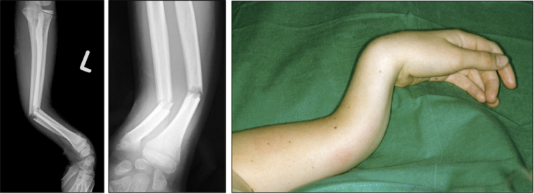 Frakturen im Kindesalter – mySurgery